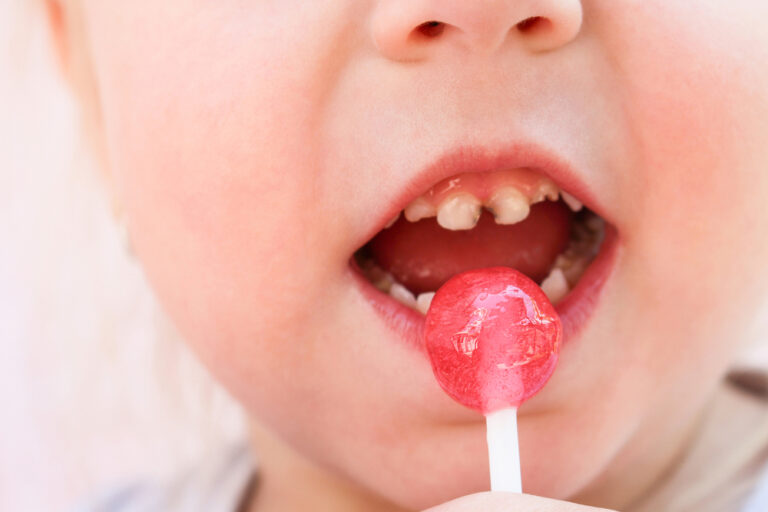 Dientes Podridos En Niños Tratamiento Y Prevención